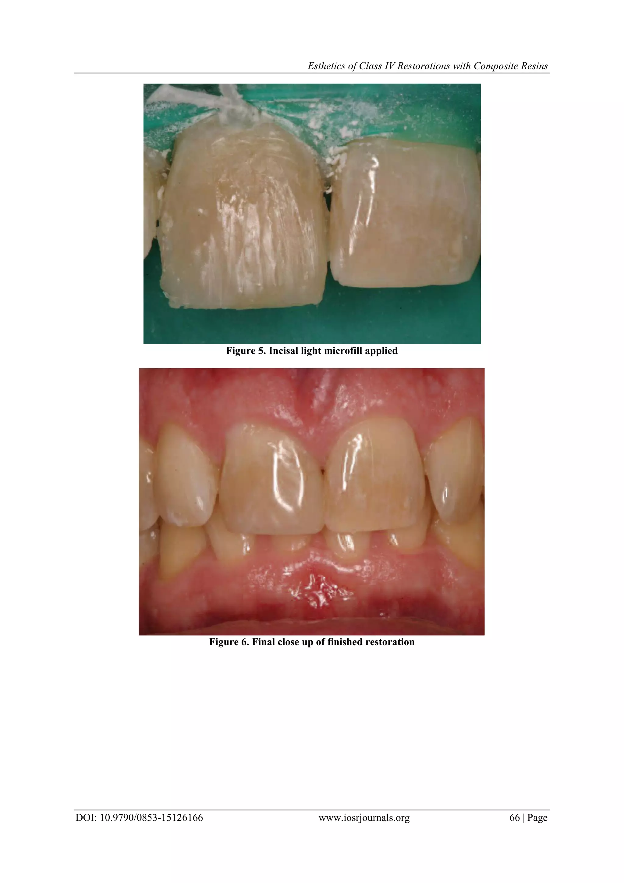 Esthetics of Class IV Restorations with Composite Resins | PDF