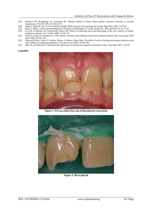 Esthetics of Class IV Restorations with Composite Resins | PDF