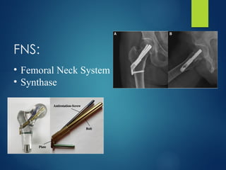 Femoral Neck Fractures presentation .pptx