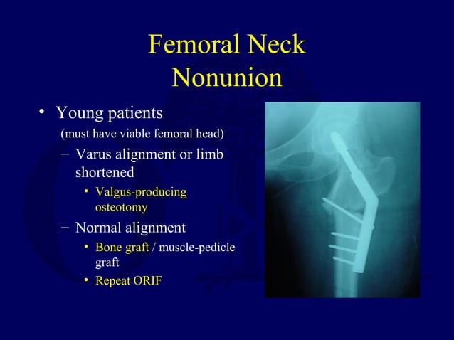L02 femoral neck fx | PPT