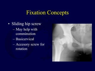 L02_Femoral_Neck_Fx_OTA-2015-Lin-Merkotaedits-revisedCAL27Apr2016-FINAL.ppt