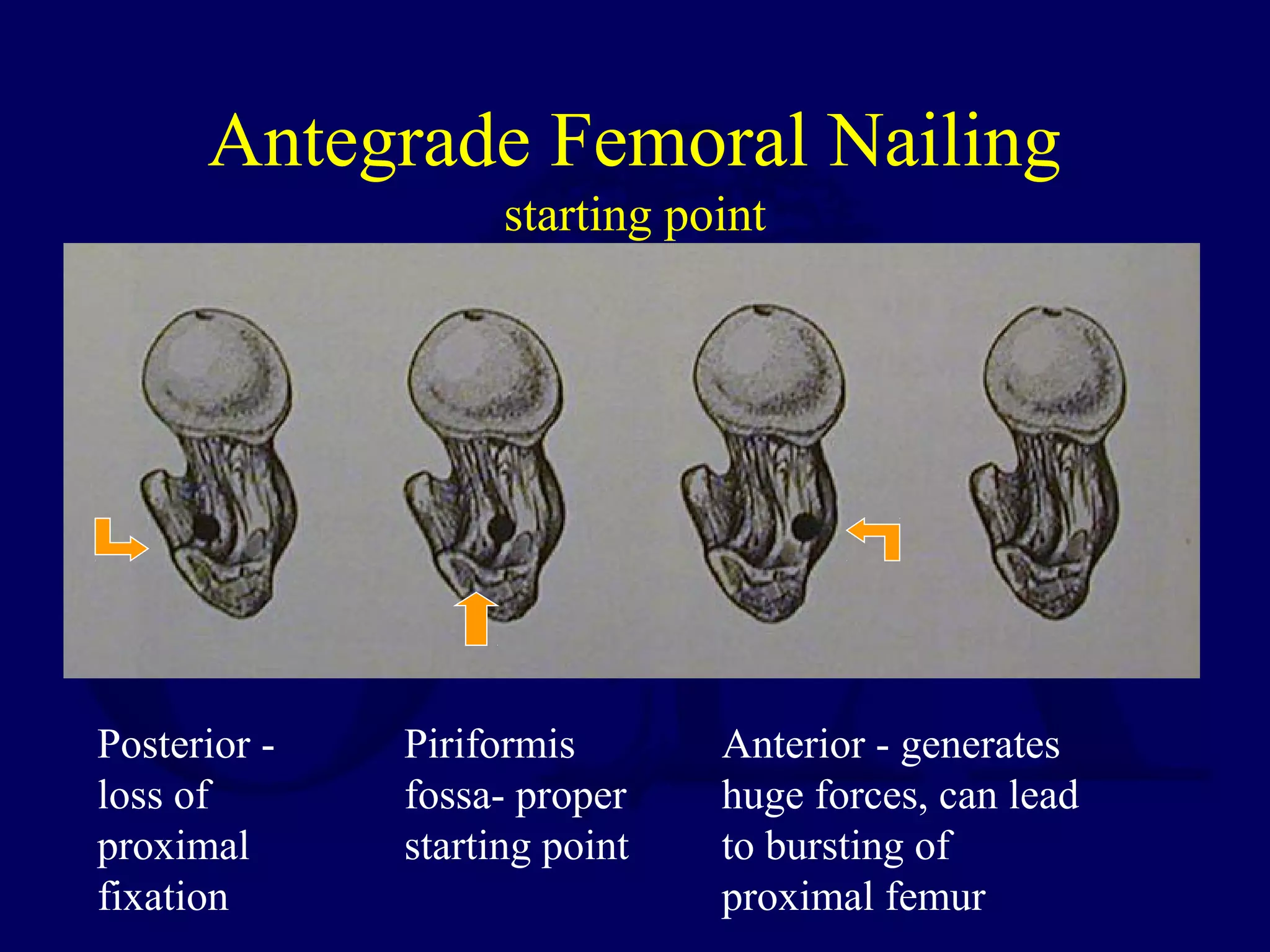L04 femur shaft, st fx | PPT