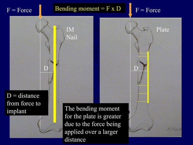 L04 femur shaft, st fx | PPT