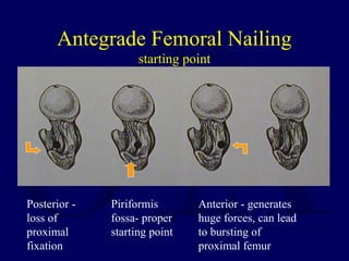 Piriform Fossa Femur