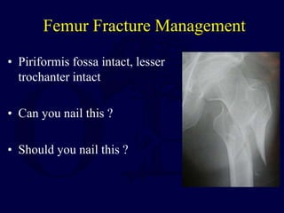 fracture Shaft of femur in lower bone .ppt