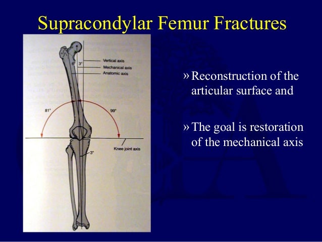L05 distal femur fx