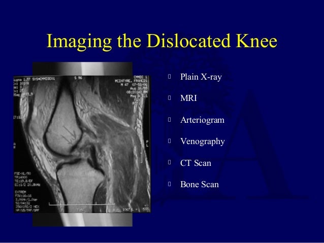 L06 knee dislocations