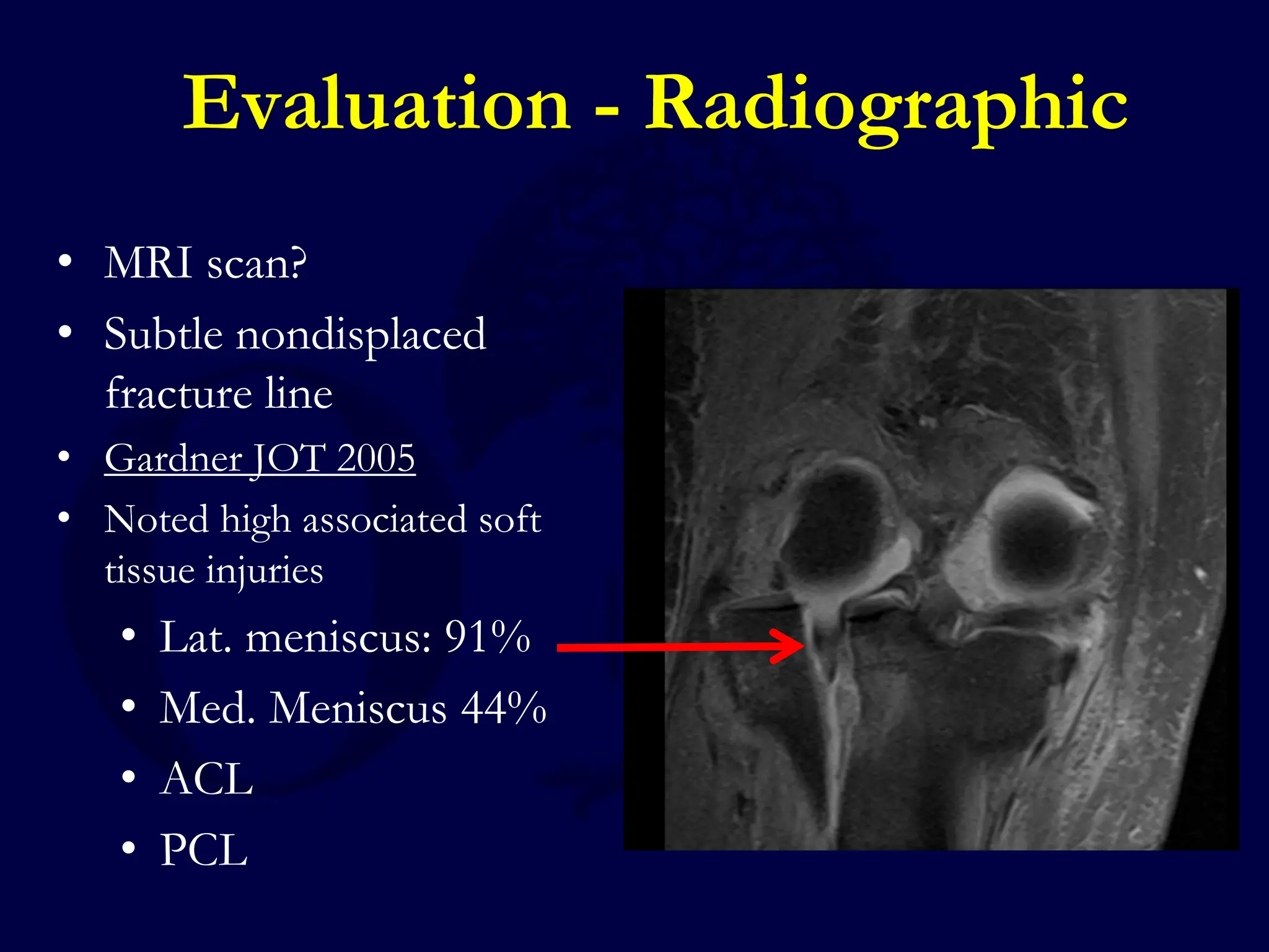 L08 - Ly Tibial Plateau Fractures-Ly-OTA-FINAL Revised5-11-2016_0.pdf