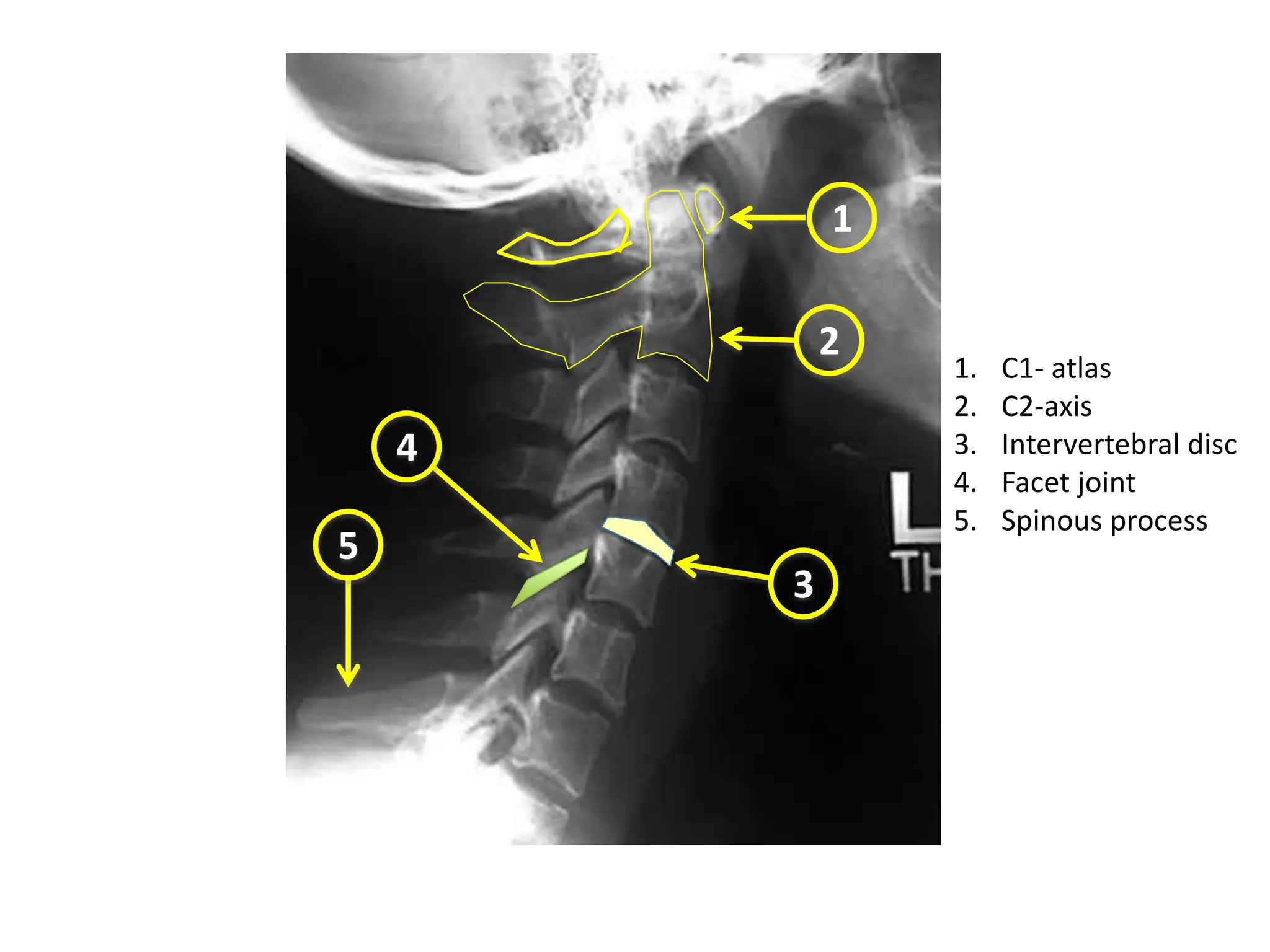 L1-vertebra Radiological -Anatomy. pptt | PPT | Death, Injury, or ...