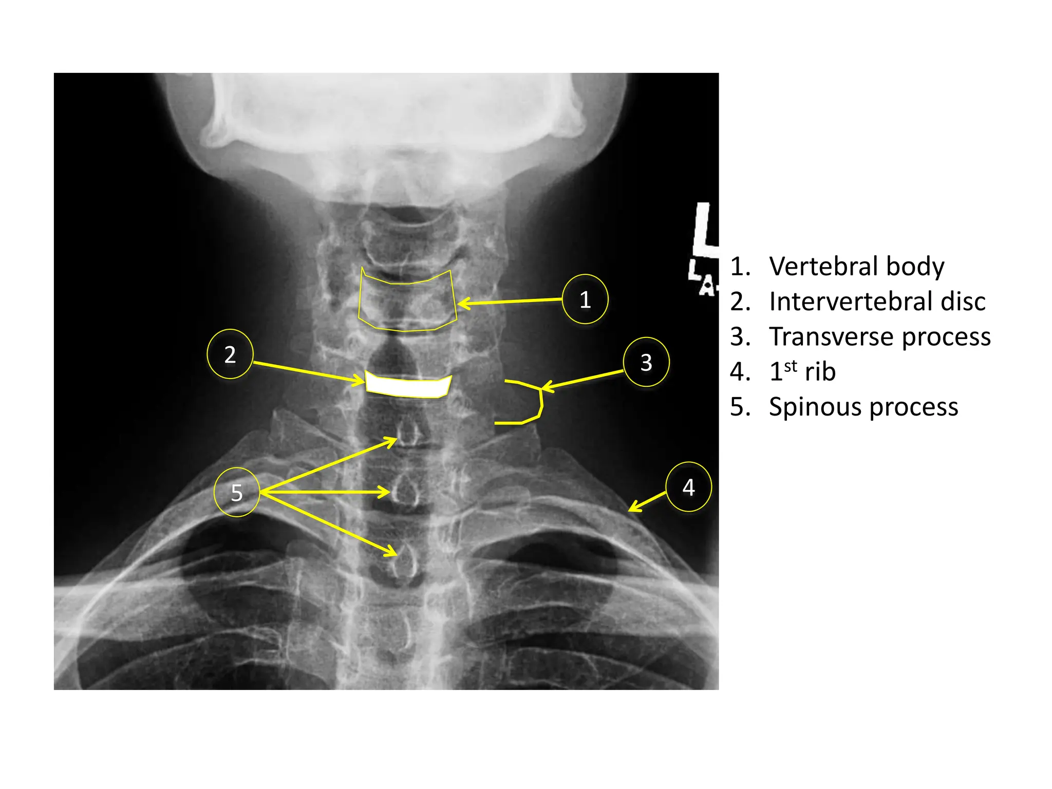 L1-vertebra Radiological -Anatomy. pptt | PPT | Death, Injury, or ...