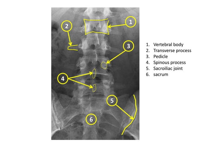 L1-vertebra Radiological -Anatomy. pptt | PPT | Death, Injury, or ...