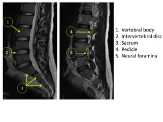 L1-vertebra Radiological -Anatomy. pptt | PPT