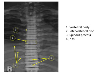 L1-vertebra Radiological -Anatomy. pptt | PPT