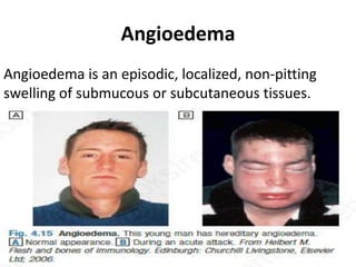 L 11 12 .Approach to edema & clubbing | PPTX