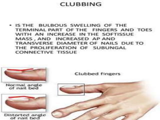 L 11 12 .Approach to edema & clubbing | PPTX
