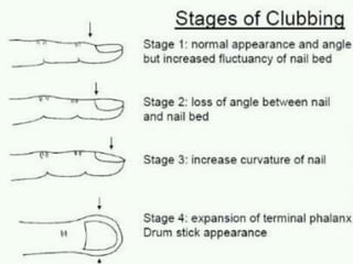 L 11 12 .Approach to edema & clubbing | PPTX