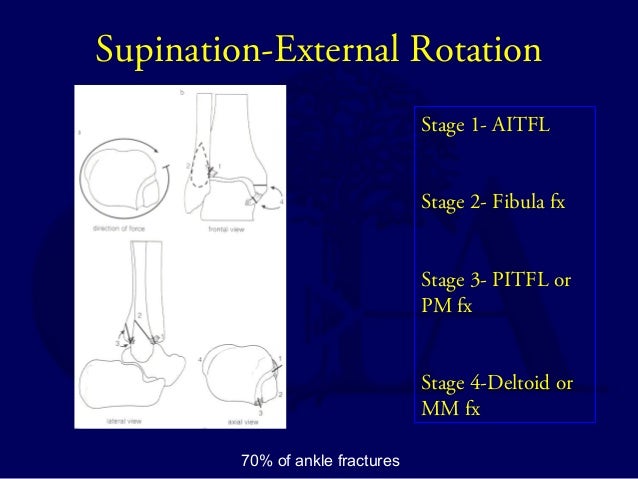 ankle fractures