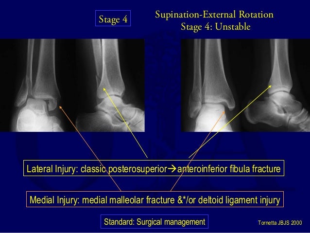 ankle fractures