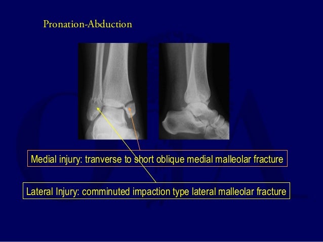 ankle fractures