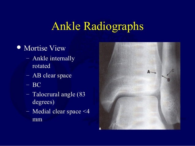 L13 ankle ligament injuries