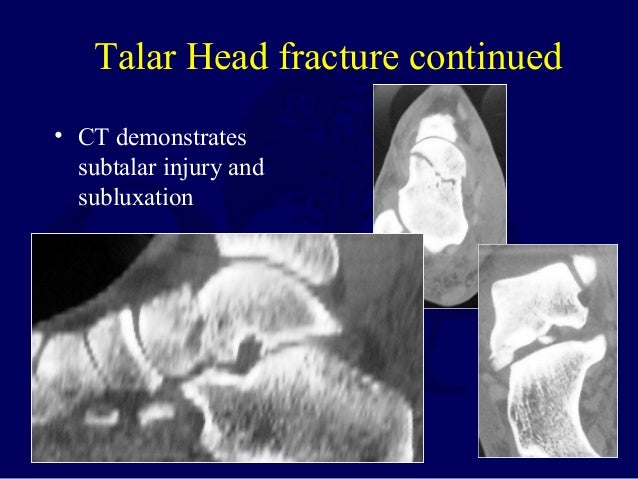 L14 talus fxs & dislocation