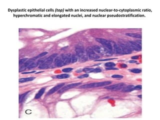 L17 neoplastic polyps | PPT