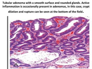 L17 neoplastic polyps | PPT