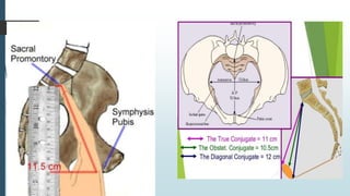 L32 Abnormal labor | PPTX