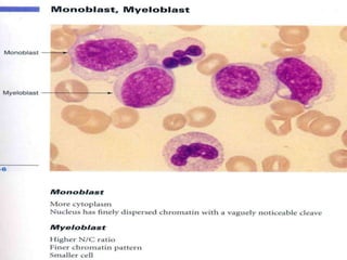 Monoblast Vs Myeloblast