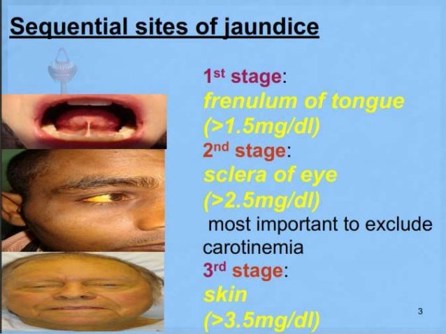 L 2 Approach To Jaundice