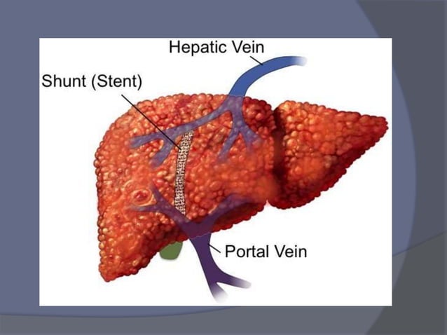 Internal Medicine Gi Bleeding Simple Pptx