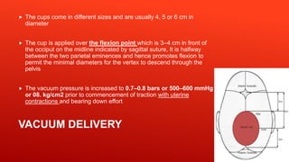 L34 Operative delivery | PPT