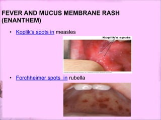 L3.approach to fever | PPT