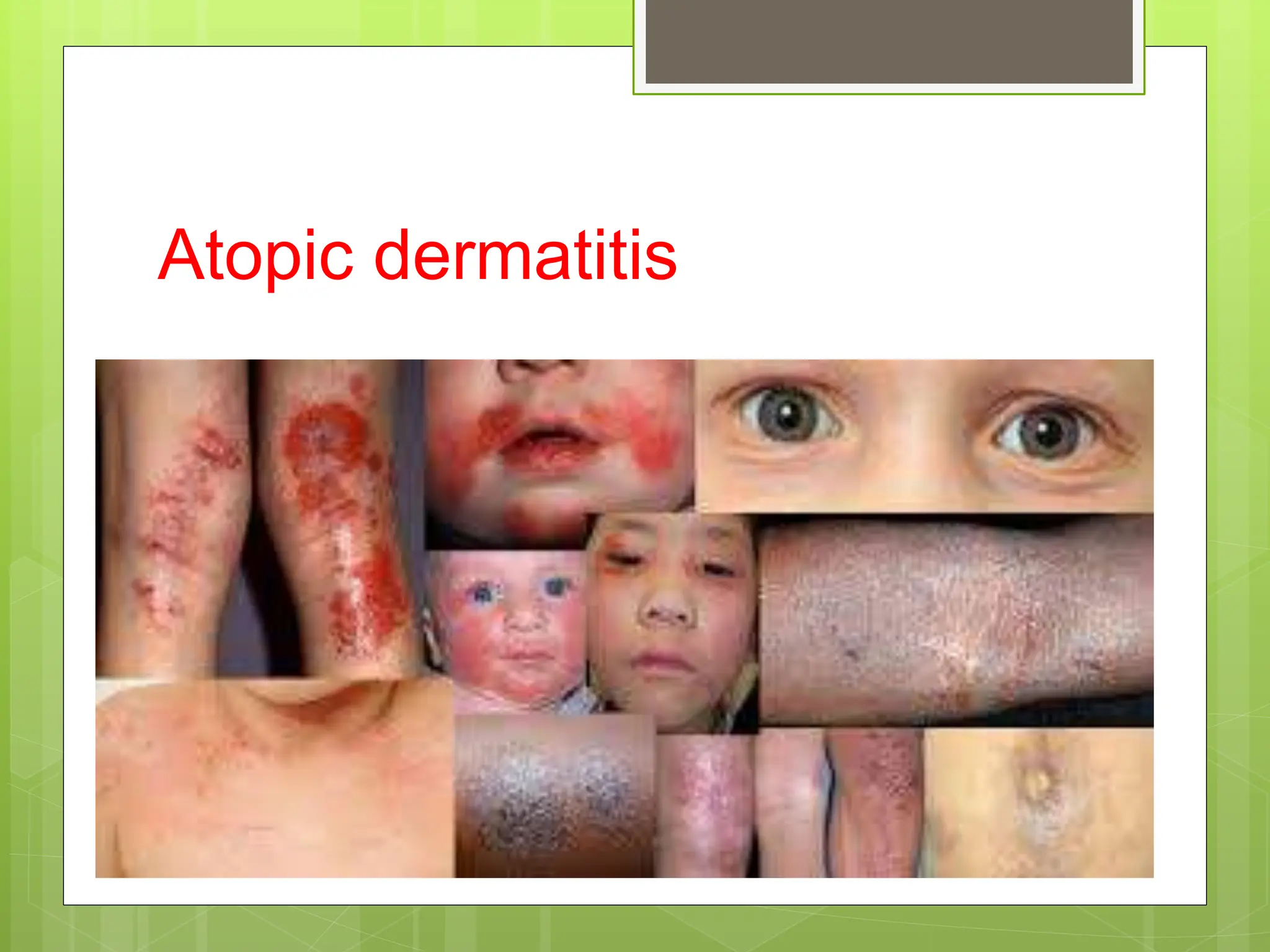 L3-Dermatitis - eczema and related disorder | PPT