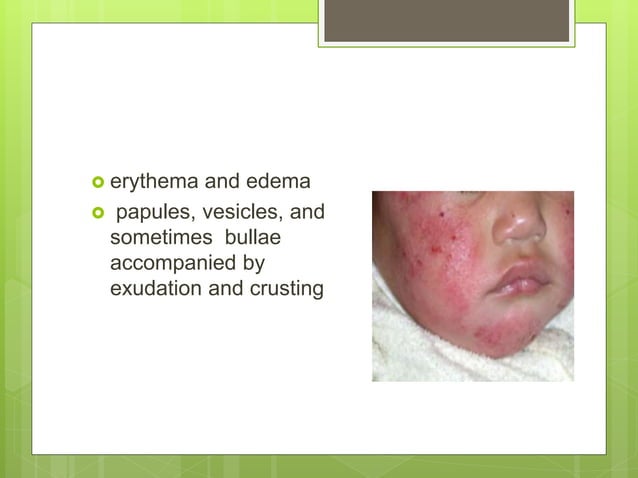 L3-Dermatitis - eczema and related disorder | PPT