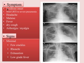 Pneumonia.ppt