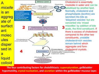 L30 gallstones student | PPT