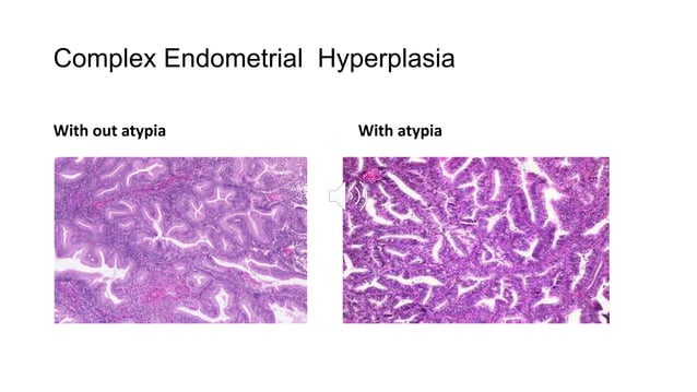 uterus pathological lesions | PPT