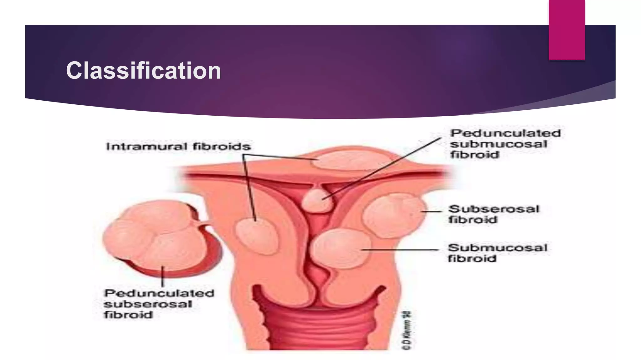 L48 Uterine Fibroids | PPTX