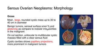 Ovarian tumors | PPTX