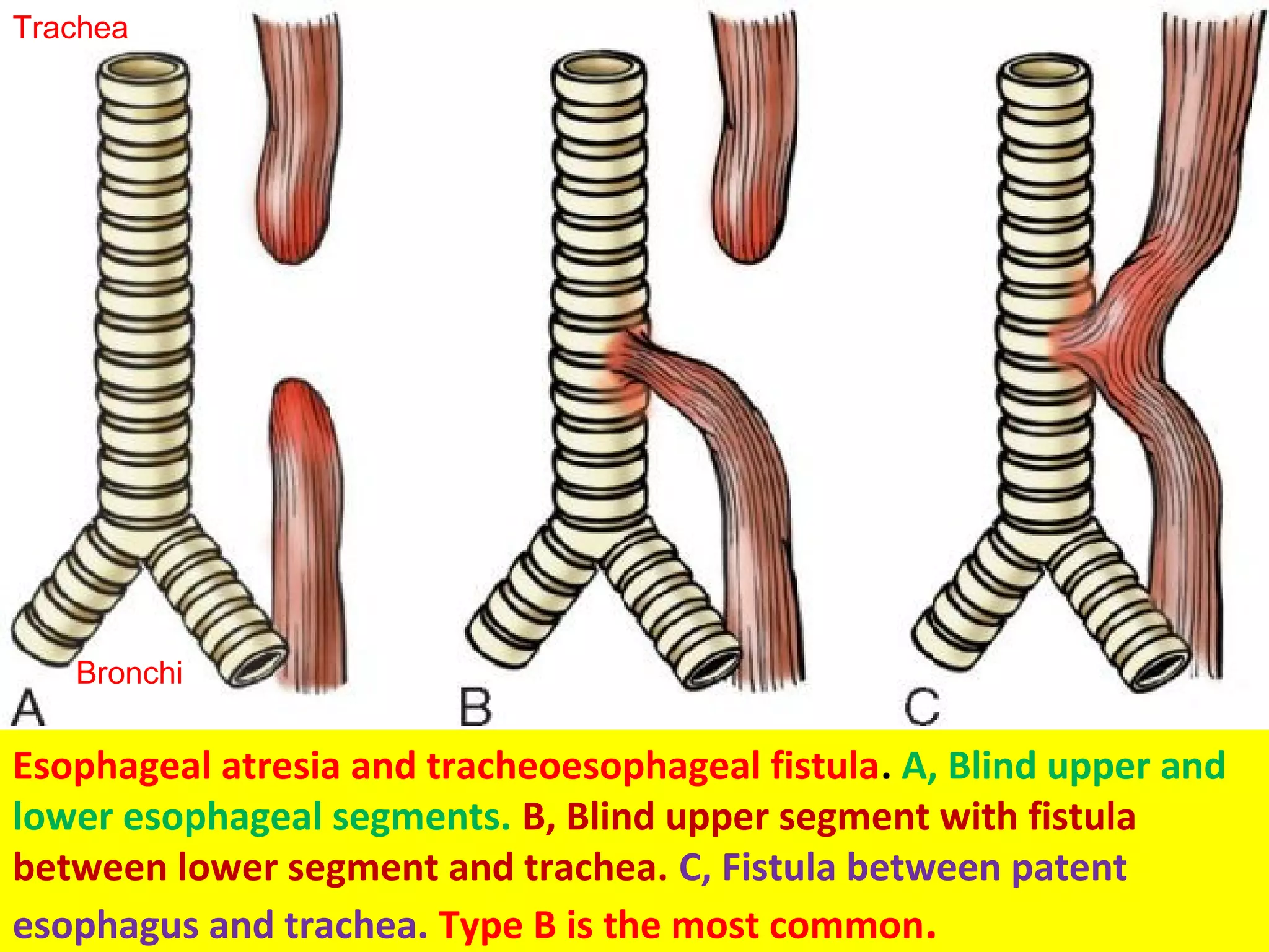 Esophageal disorders | PPT