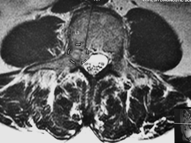 L3 l4 disc extrusion | PPT