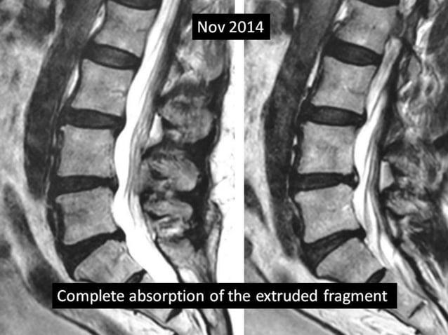 L3 l4 disc extrusion