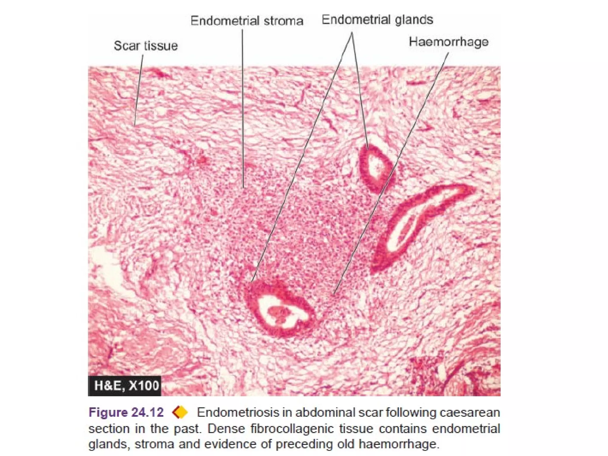 Non neoplastic disorders of endometrium | PPT
