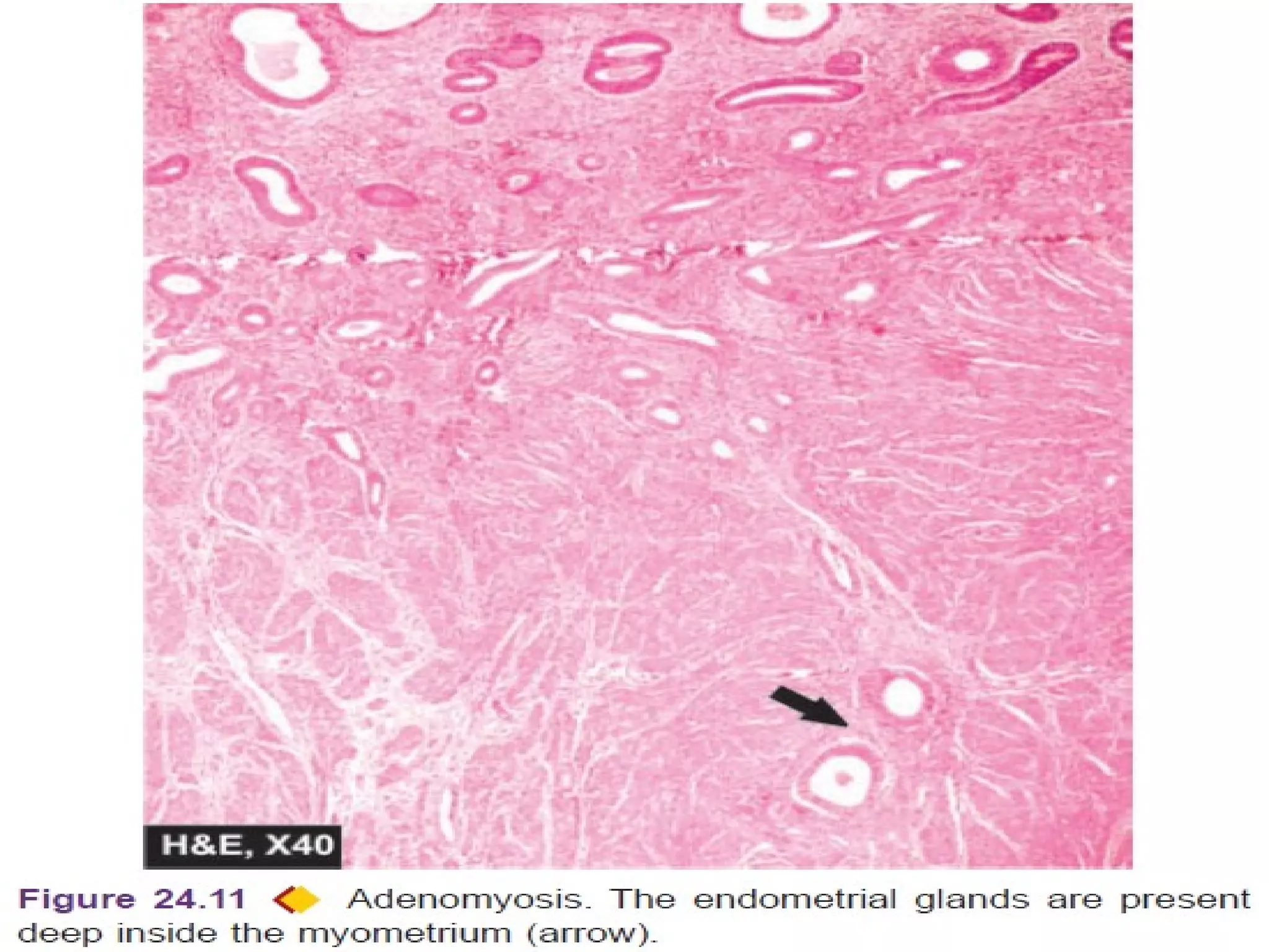 Non neoplastic disorders of endometrium | PPT