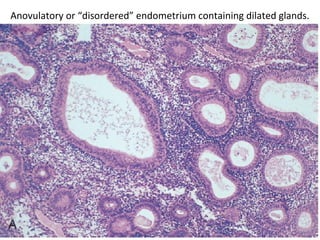 Non neoplastic disorders of endometrium | PPT