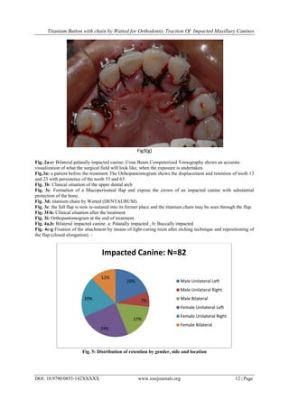 Titanium Button With Chain by Watted For Orthodontic Traction of ...