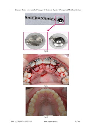 Titanium Button With Chain by Watted For Orthodontic Traction of ...