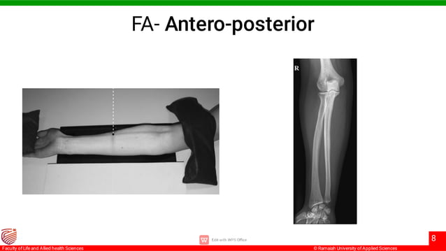 radiography of forearm from clarks positiong | PPT