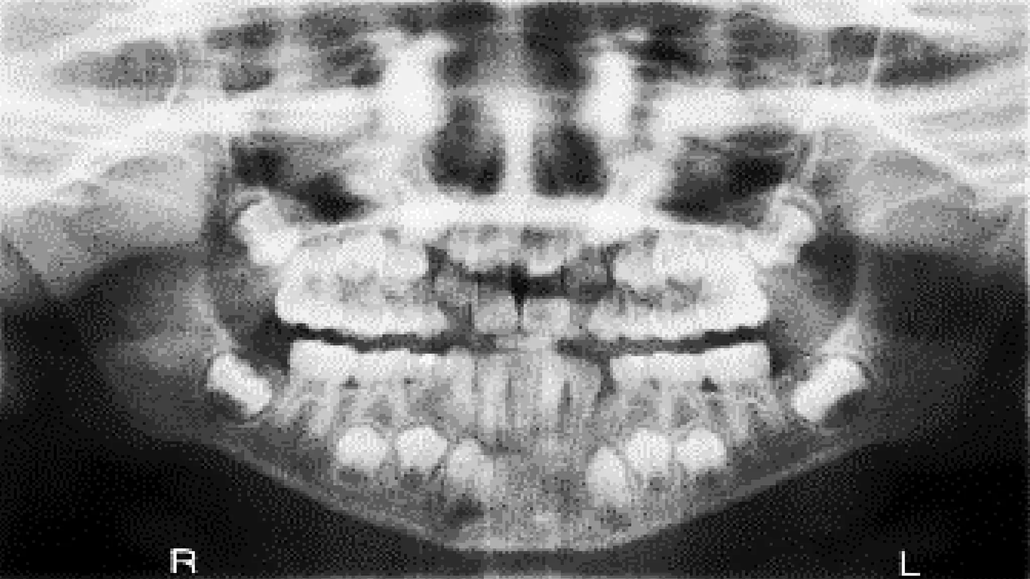 Morphology of mandibular incisors | PPT